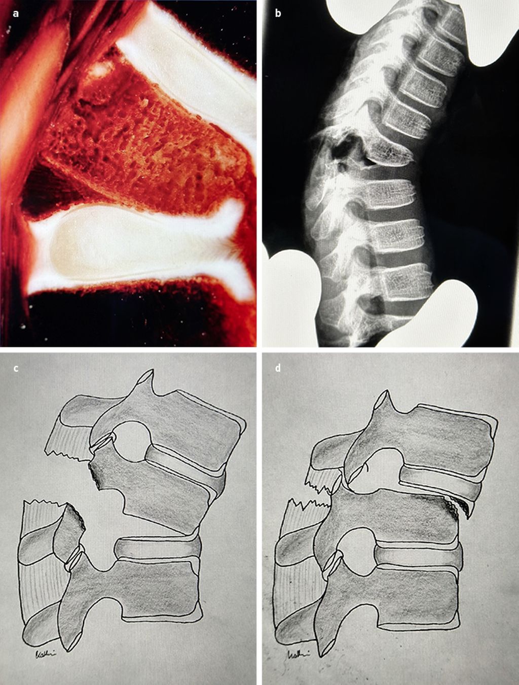 Besonderheiten bei Wirbelsäulenverletzungen im Kindesalter - Orthopädie & Traumatologie ...